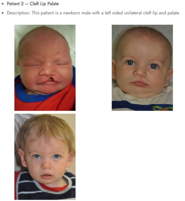 Pediatric Cleft Lip and Palate